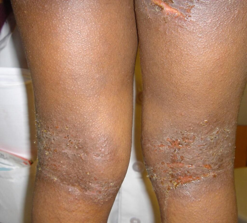 Image Library - Eczema in Skin of Color